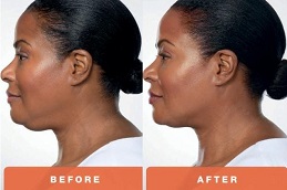 Belkyra Treatment - Double Chin Removal Dubai - Estheticare Dubai