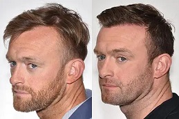 Robotic Hair Transplant in Dubai & Abu Dhabi - Cost & Deals | Esthetic Care