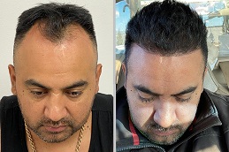 Robotic Hair Transplant in Dubai & Abu Dhabi - Cost & Deals | Esthetic Care
