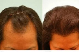 Natural Hairline Treatment in Dubai & Abu Dhabi - Men & Women | Price