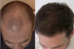 Robotic Hair Transplant in Dubai & Abu Dhabi - Cost & Deals | Esthetic Care