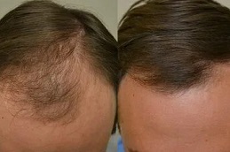 Robotic Hair Transplant in Dubai & Abu Dhabi - Cost & Deals | Esthetic Care